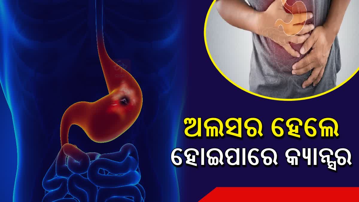 ଅତ୍ୟଧିକ ପେନ୍‌କିଲର ଖାଉଛନ୍ତି କି ? ହୋଇପାରେ ଅଲସର୍‌ - Ulcer Symptom and Causes