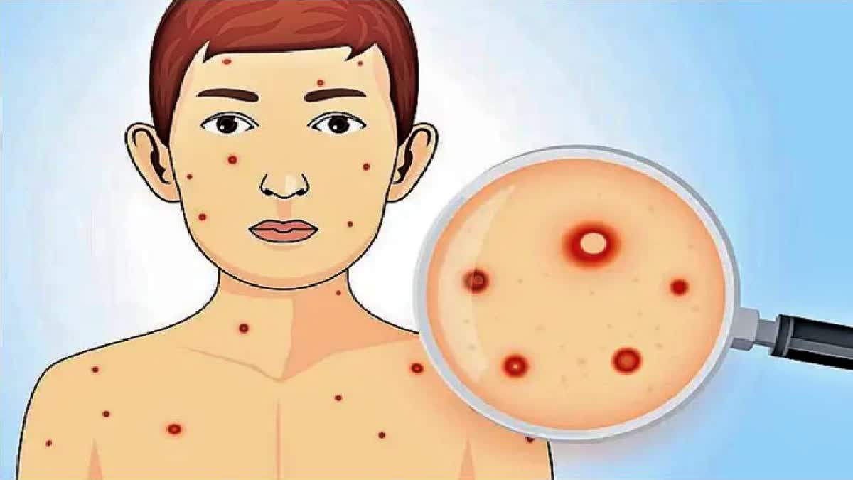 నగరవాసులను కలవరపెడుతున్న 'ఆటలమ్మ' - నిలోఫర్‌కు క్యూ కడుతున్న బాధితులు