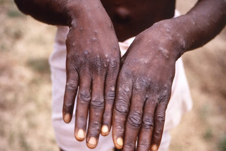 Five-year-old girl in UP's Ghaziabad with suspected Monkeypox infection ...
